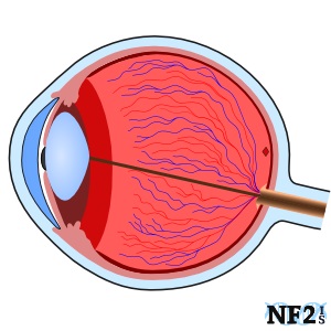 Eye and Vision Issues